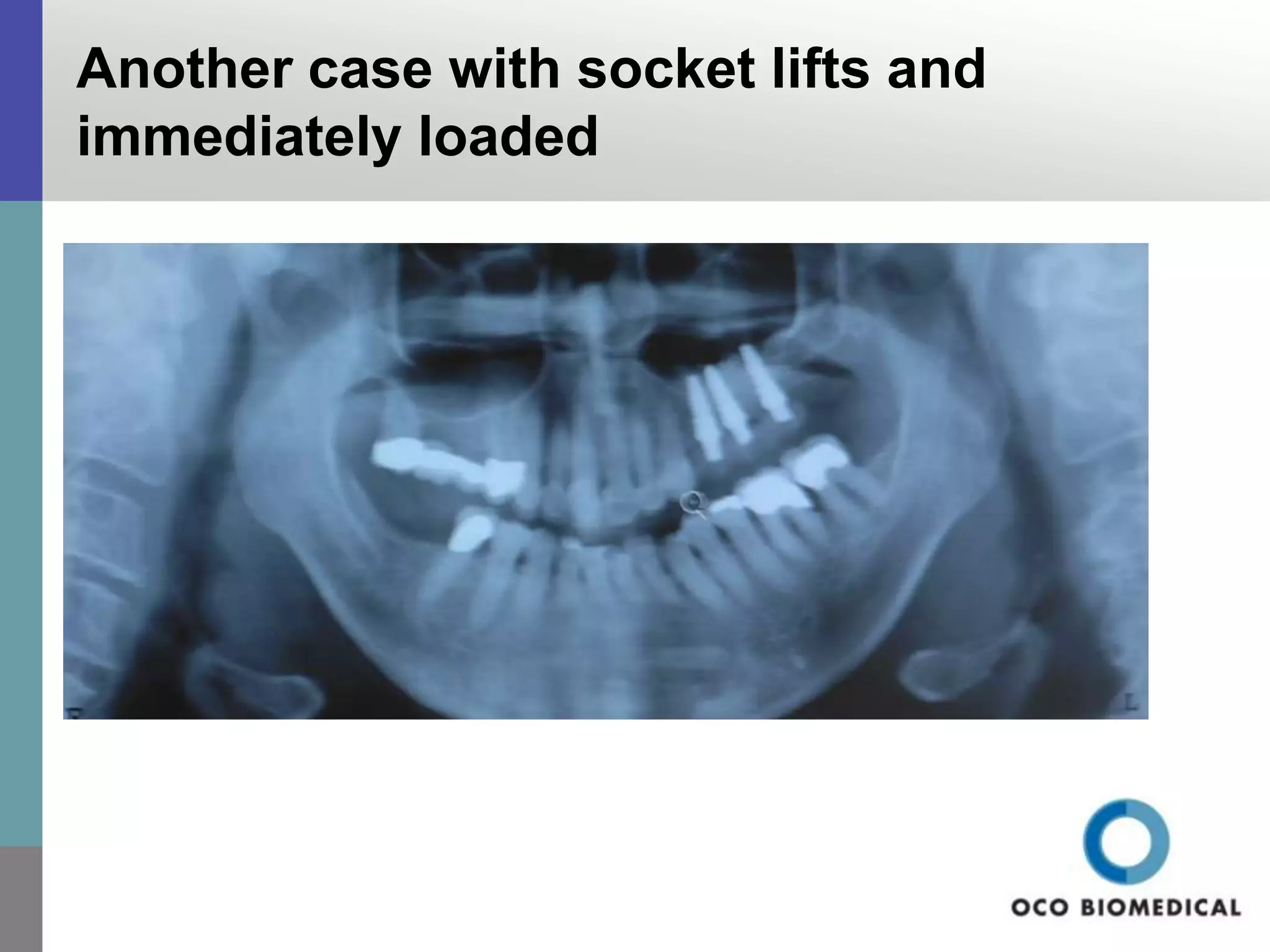 Socket sinus lift | PPTX