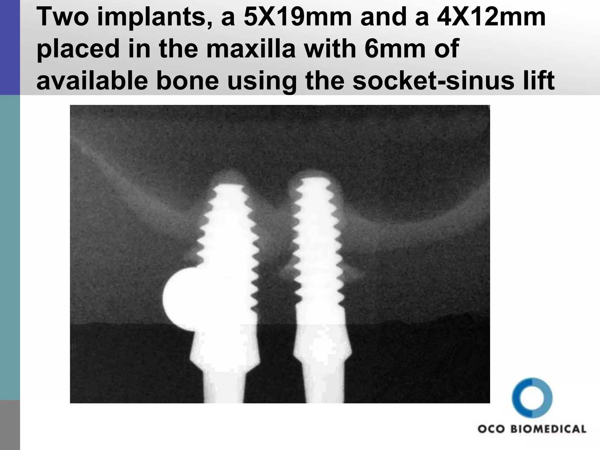 Socket sinus lift | PPTX