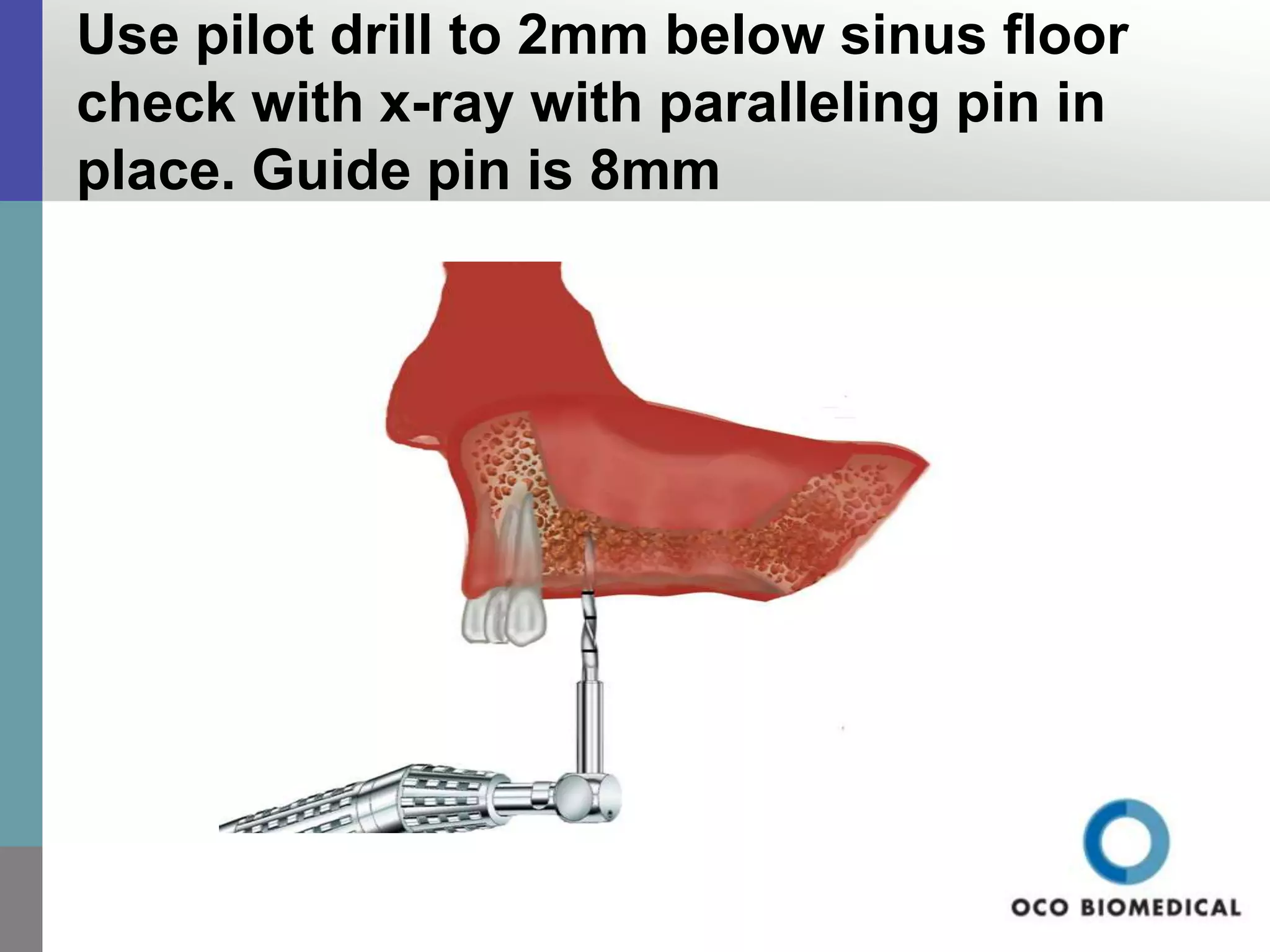 Socket sinus lift | PPTX