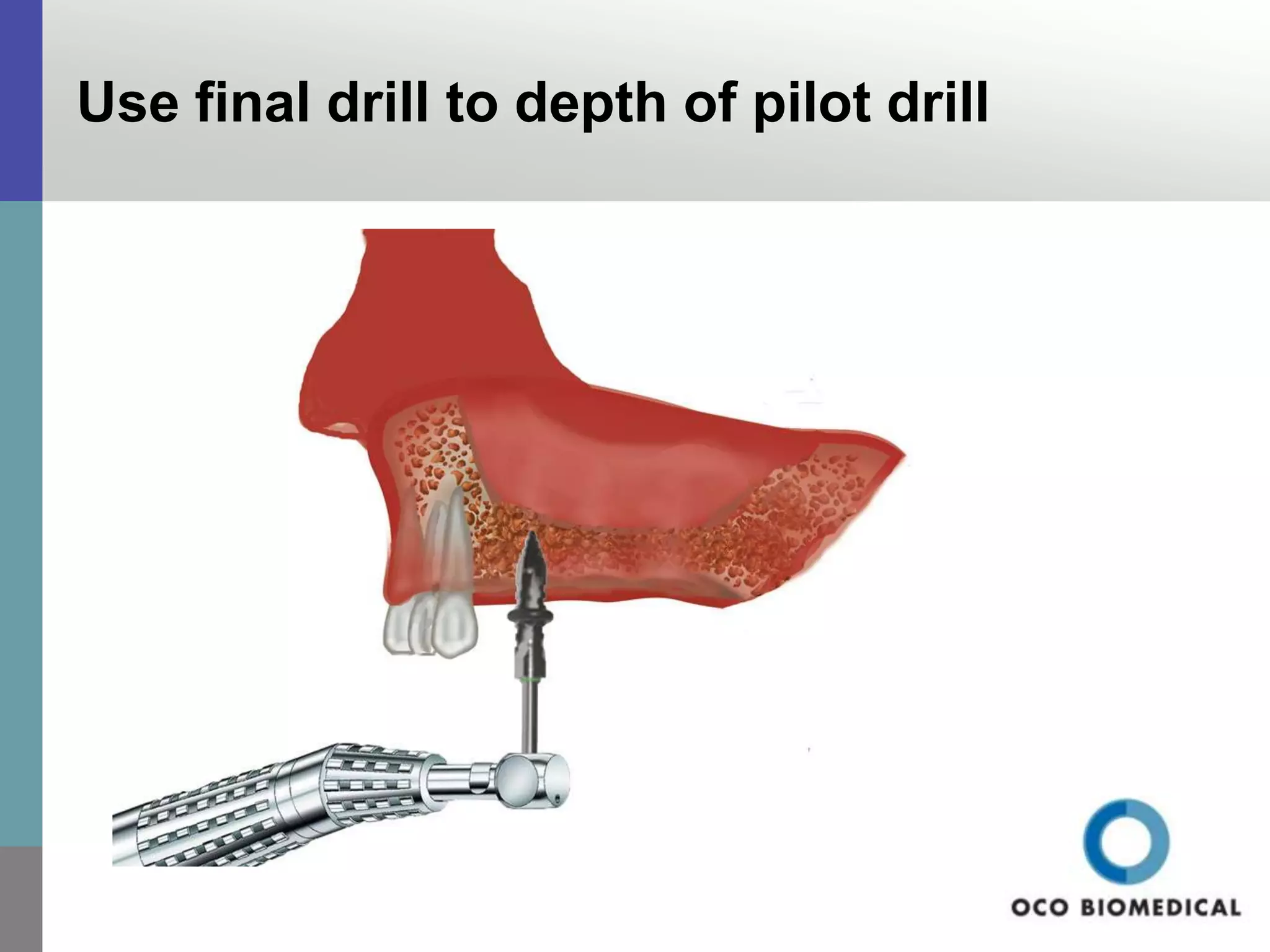 Socket sinus lift | PPTX