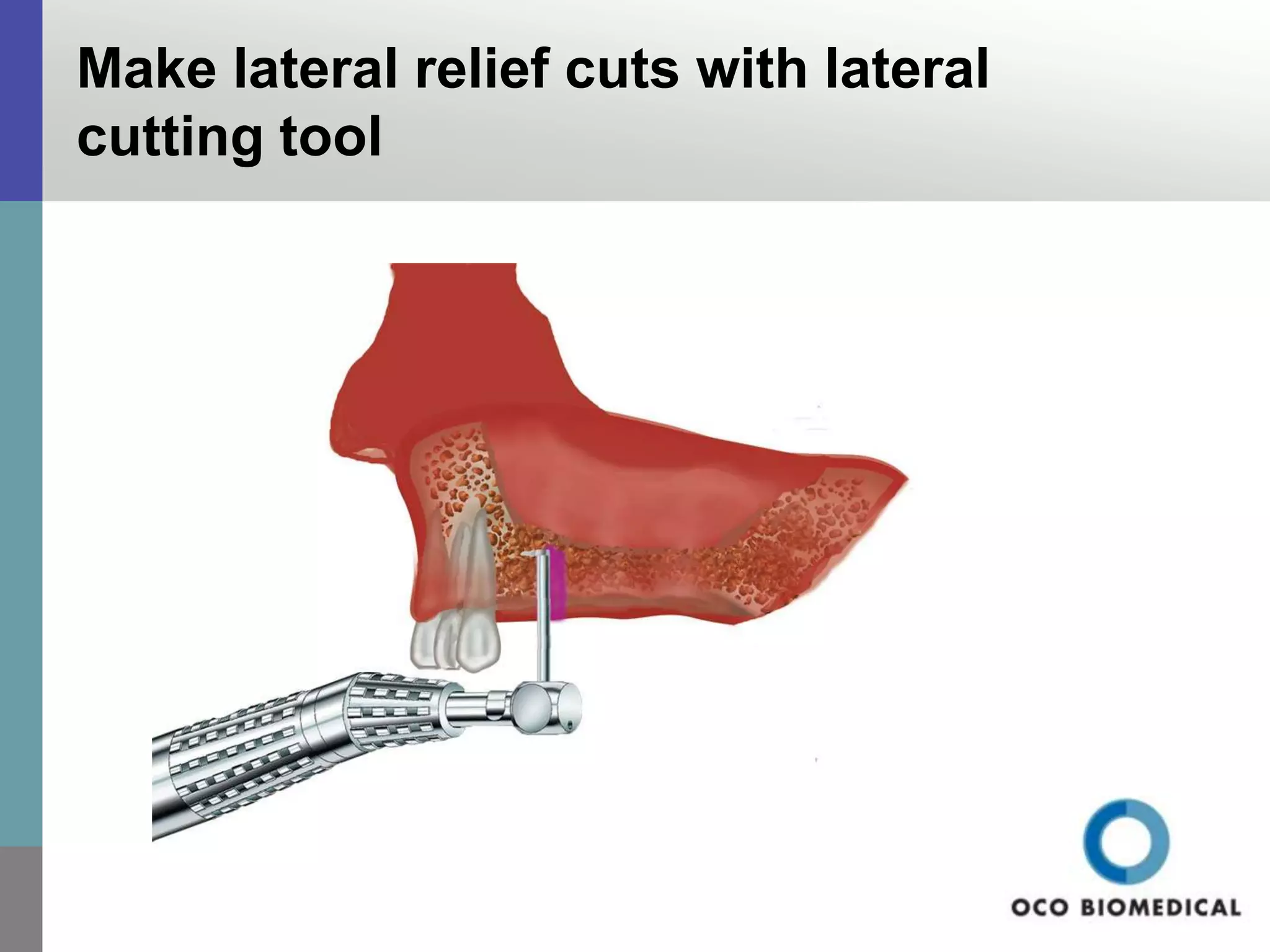 Socket sinus lift | PPTX