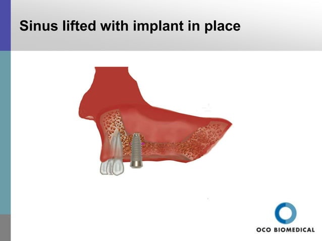 Socket sinus lift | PPT