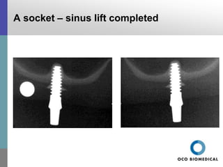 Socket sinus lift | PPTX