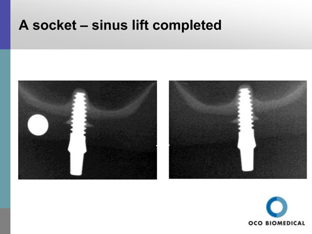 Socket sinus lift | PPT