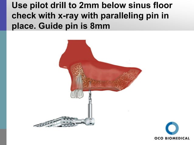 Socket sinus lift | PPT