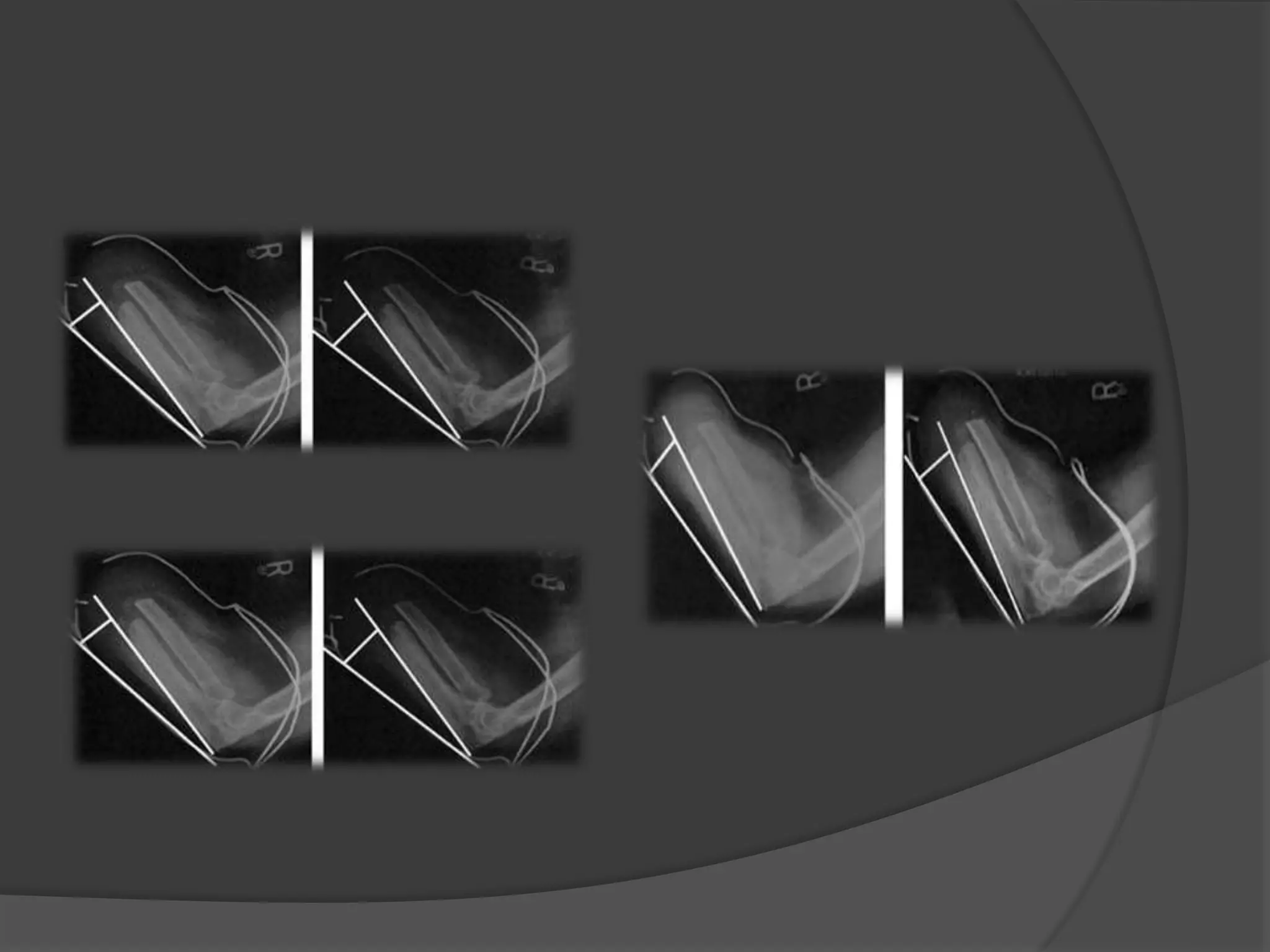 Socket variants in upper extremity prosthesis.pptx1 | PPTX