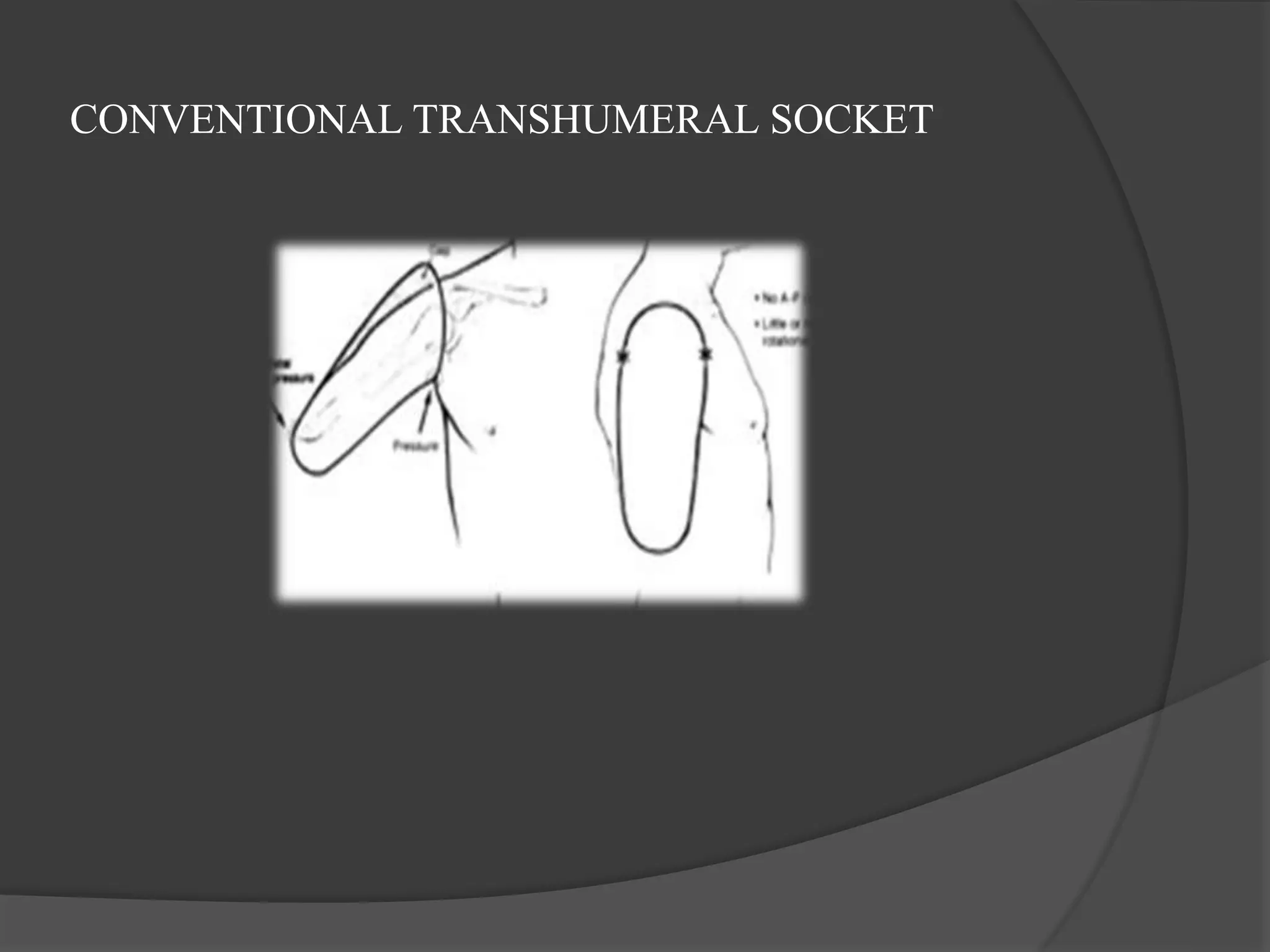 Socket variants in upper extremity prosthesis.pptx1 | PPTX