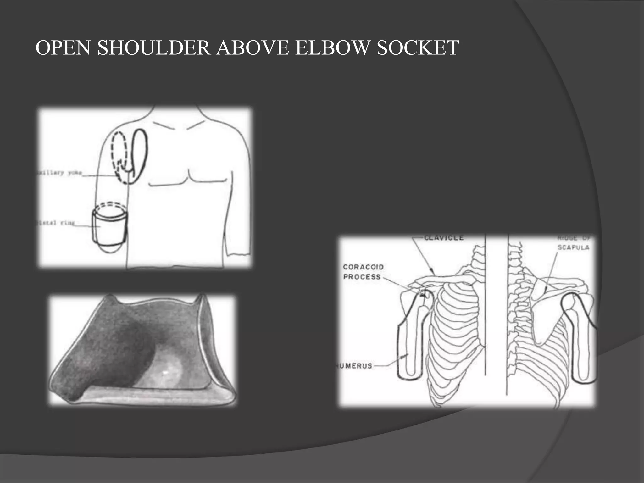 Socket variants in upper extremity prosthesis.pptx1 | PPTX