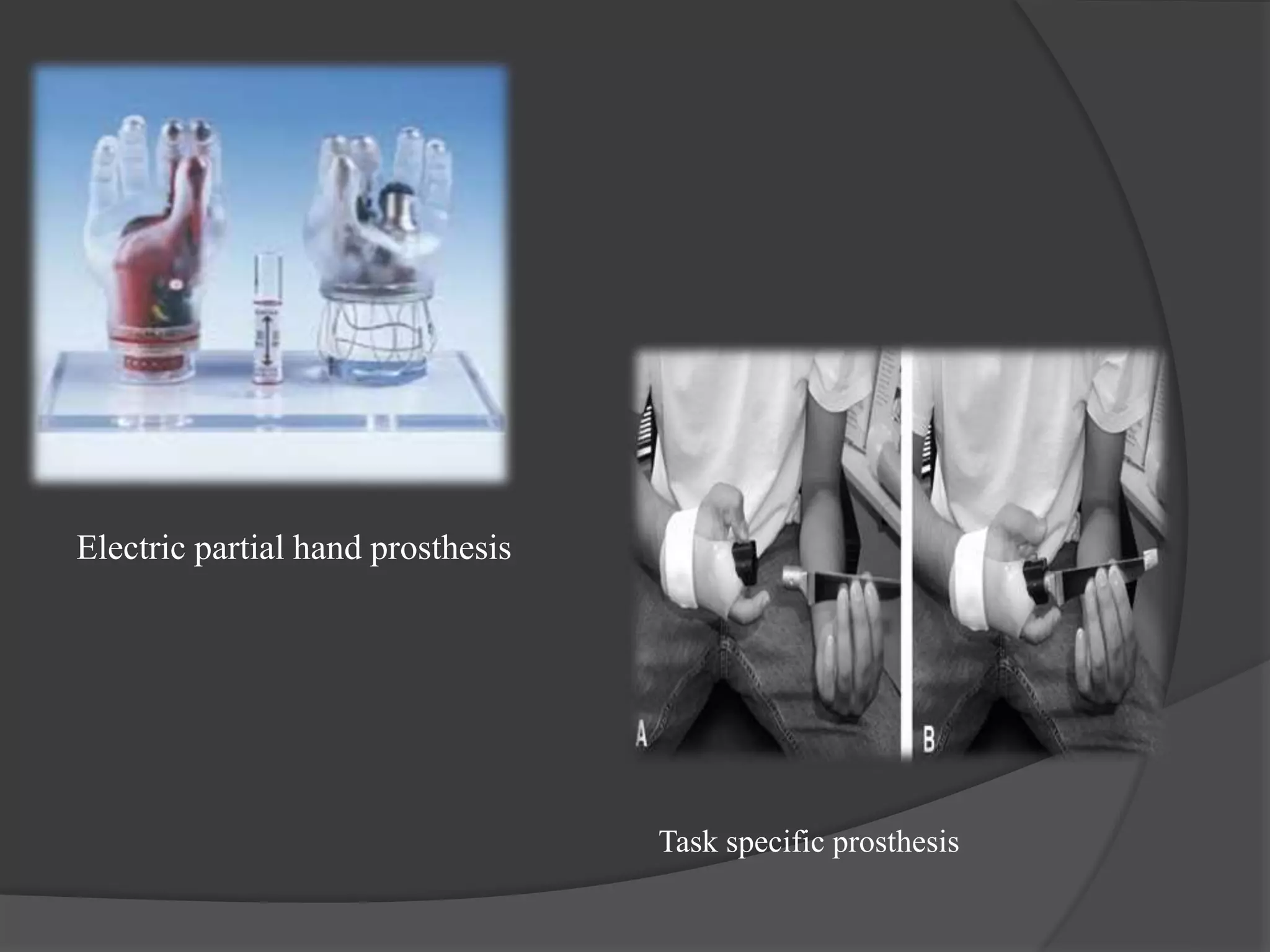 Socket variants in upper extremity prosthesis.pptx1 | PPTX