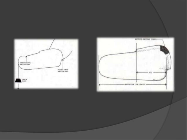 Socket variants in upper extremity prosthesis.pptx1 | PPTX