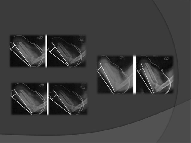 Socket variants in upper extremity prosthesis.pptx1 | PPTX