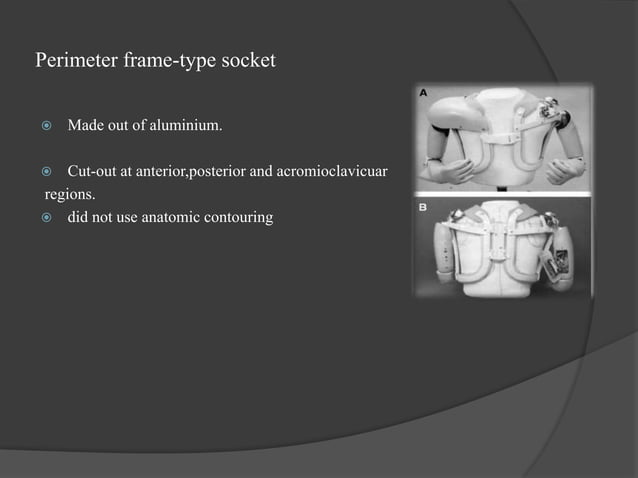 Socket variants in upper extremity prosthesis.pptx1 | PPTX