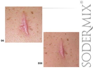 Содермикс - клинично доказана ефективност при белези, сърбеж и ...