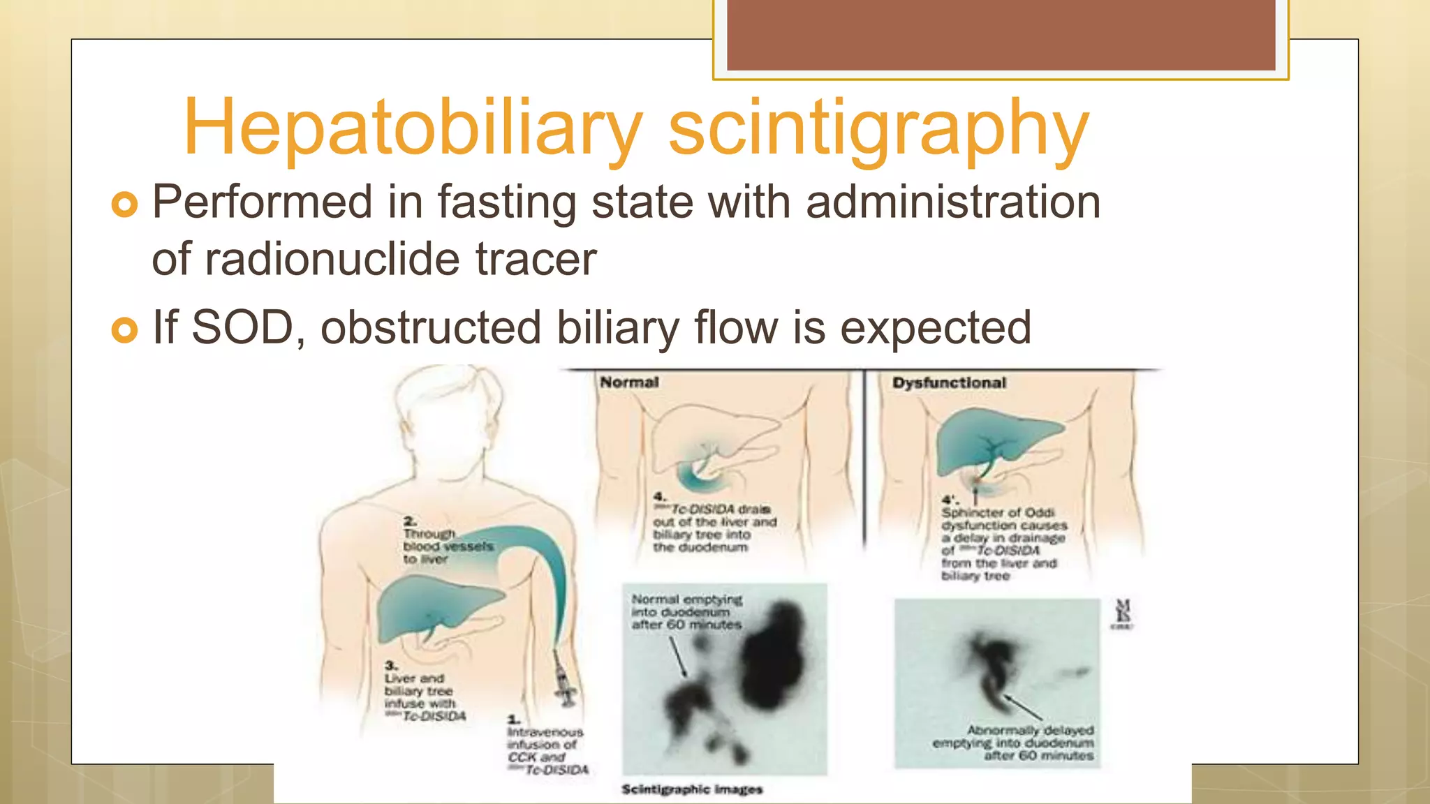 Sods sphincter of Oddi Dysfunction | PPTX