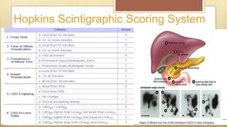 Sods sphincter of Oddi Dysfunction | PPTX