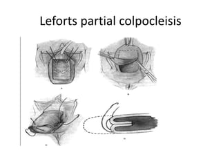 Pelvic organ prolapse | PPTX