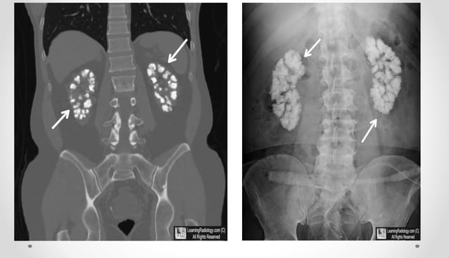 Nephrocalcinosis | PPTX