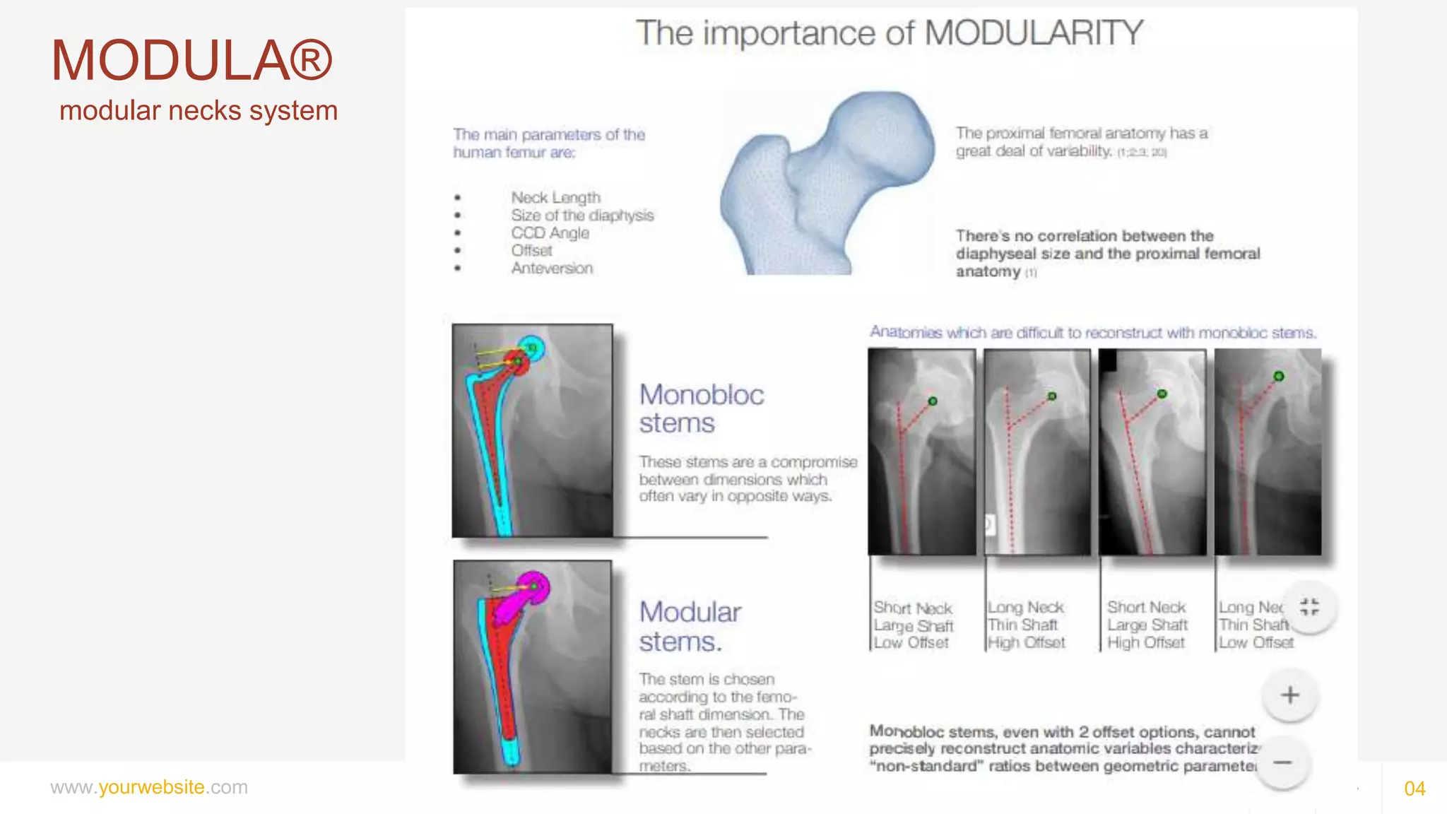 Sofcot adler ortho | PPTX
