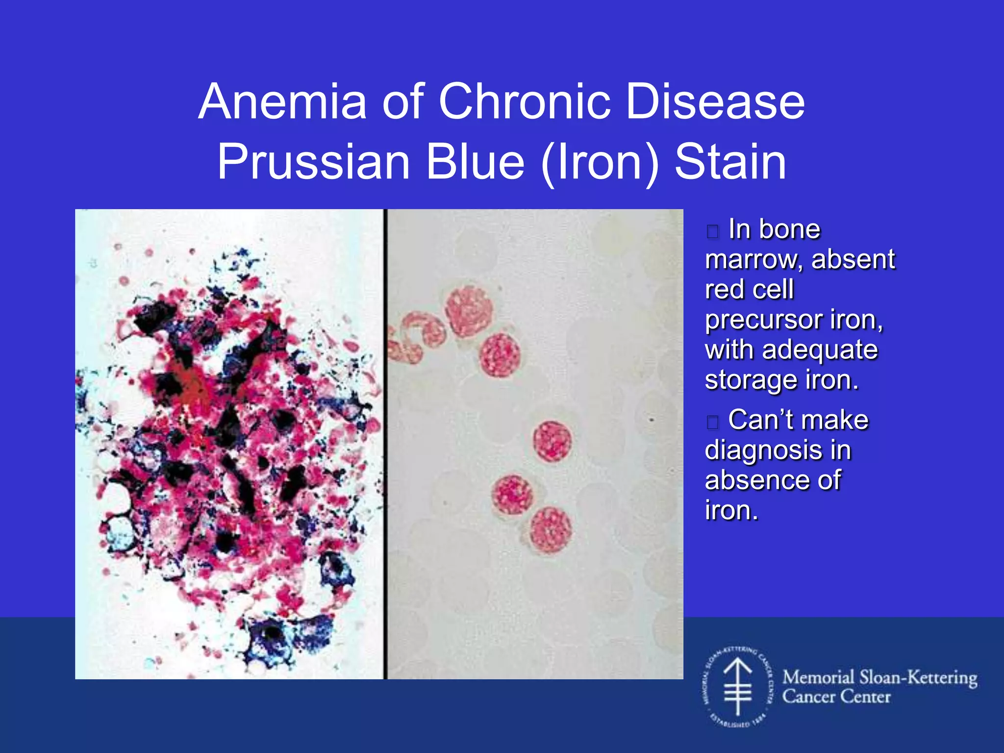 approach to the diagnosis of anemia | PPTX