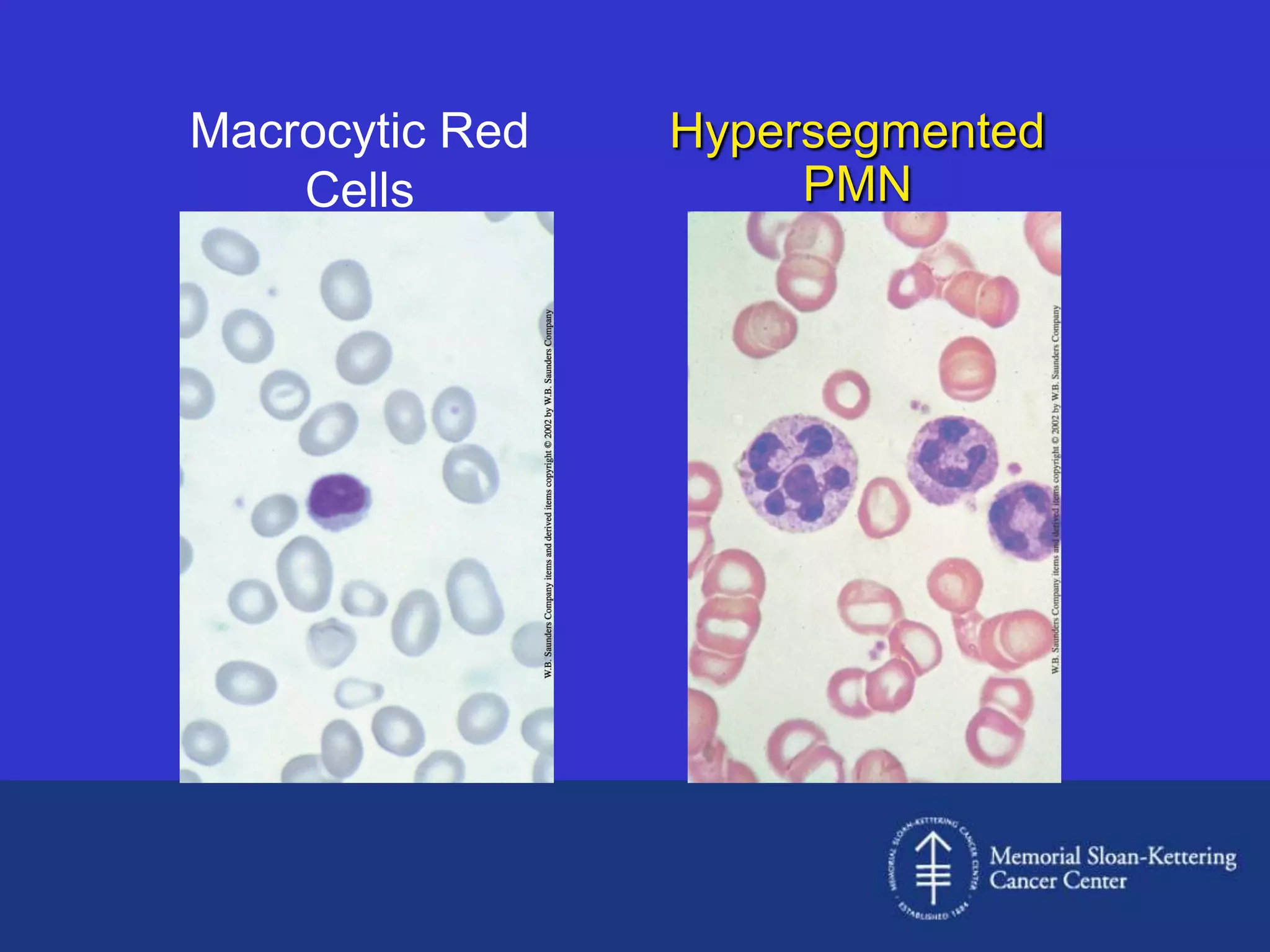 approach to the diagnosis of anemia | PPTX
