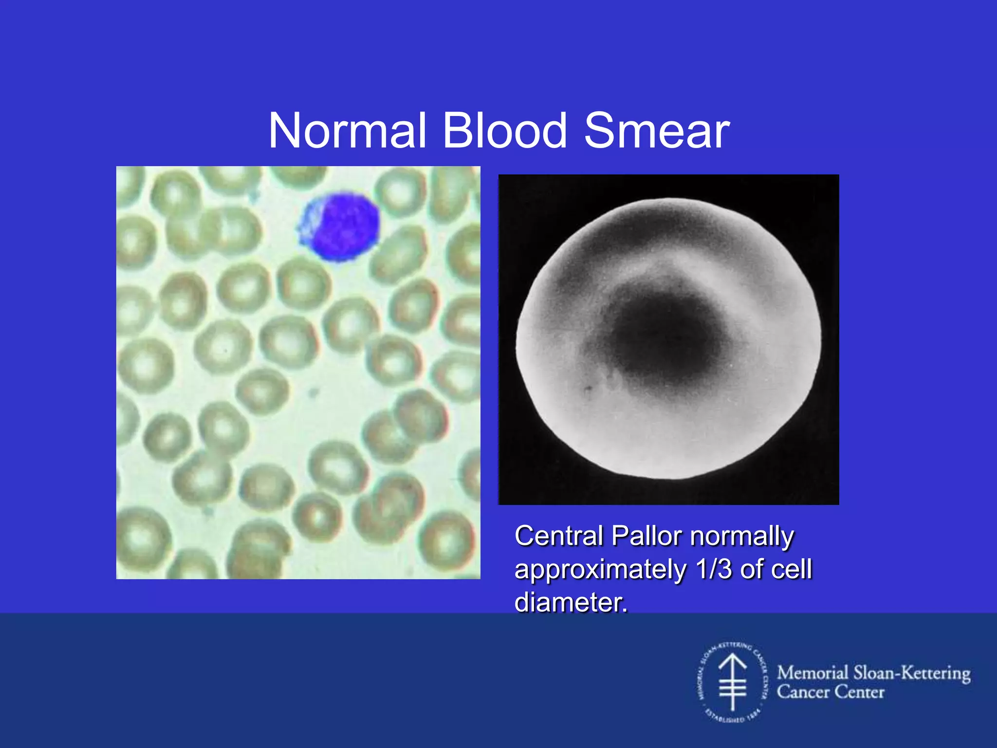 approach to the diagnosis of anemia | PPTX