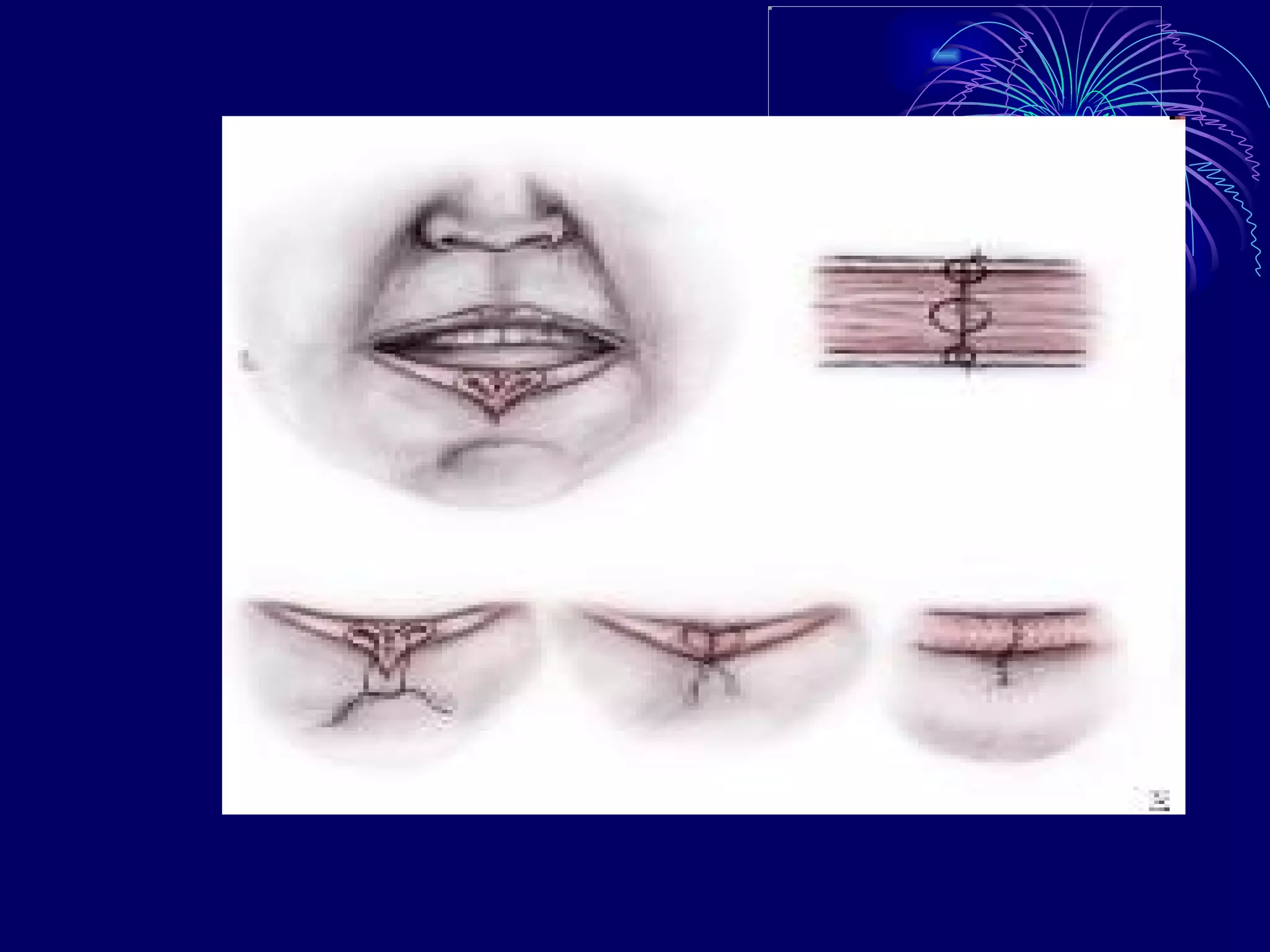 Soft Tissue Facial Injuries By Sa | PPT