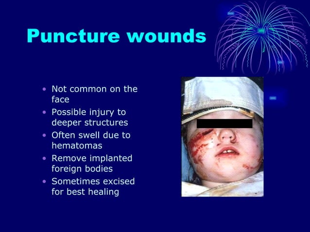 Soft Tissue Facial Injuries By Sa | PPT