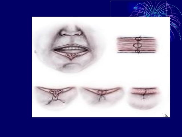 Soft Tissue Facial Injuries By Sa | PPT