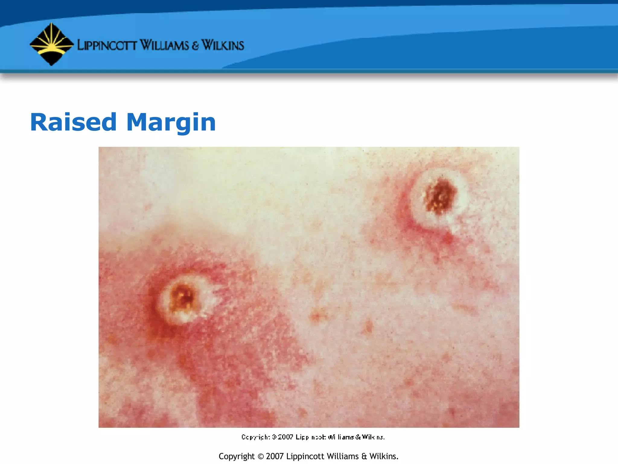 Soft Tissue Lesions | PPT