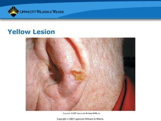 Soft Tissue Lesions | PPT