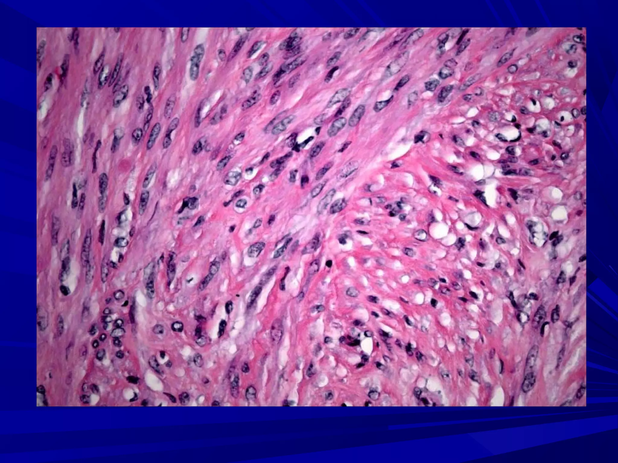 Soft Tissue Tumors 2012 Ppt