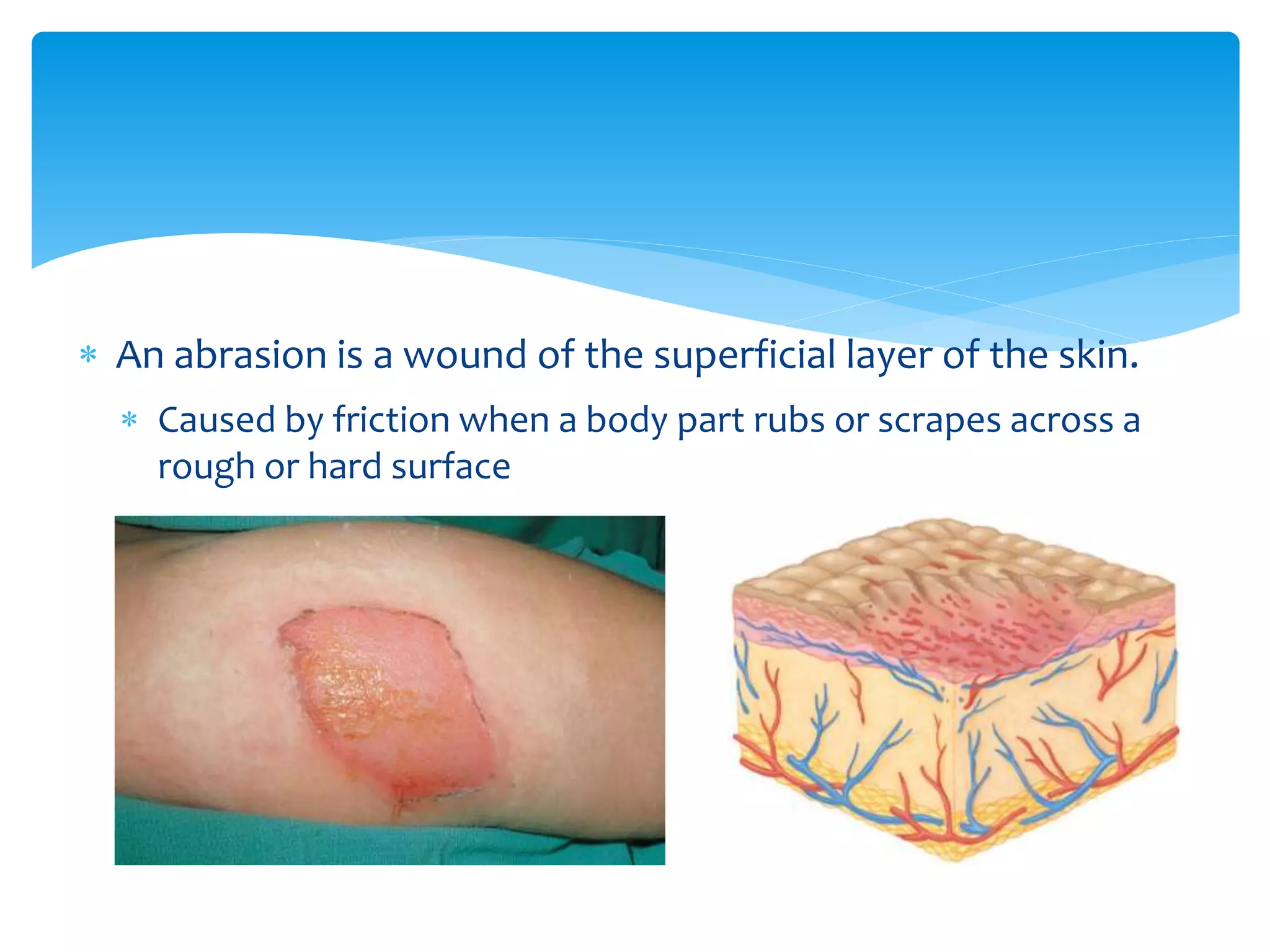 Soft-Tissue Injuries | PPTX