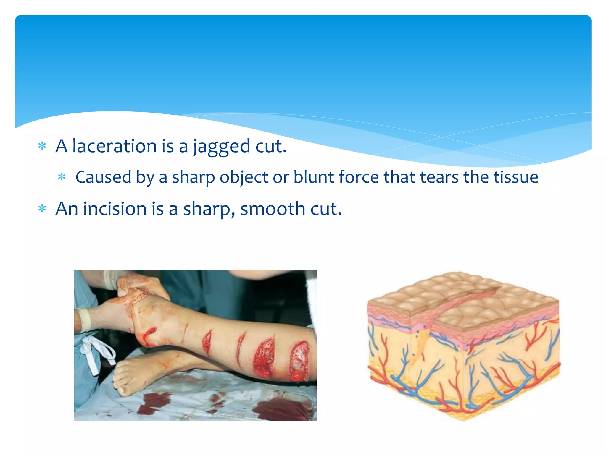 Soft-Tissue Injuries | PPTX