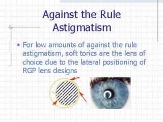 fitting soft toric lenses | PPT
