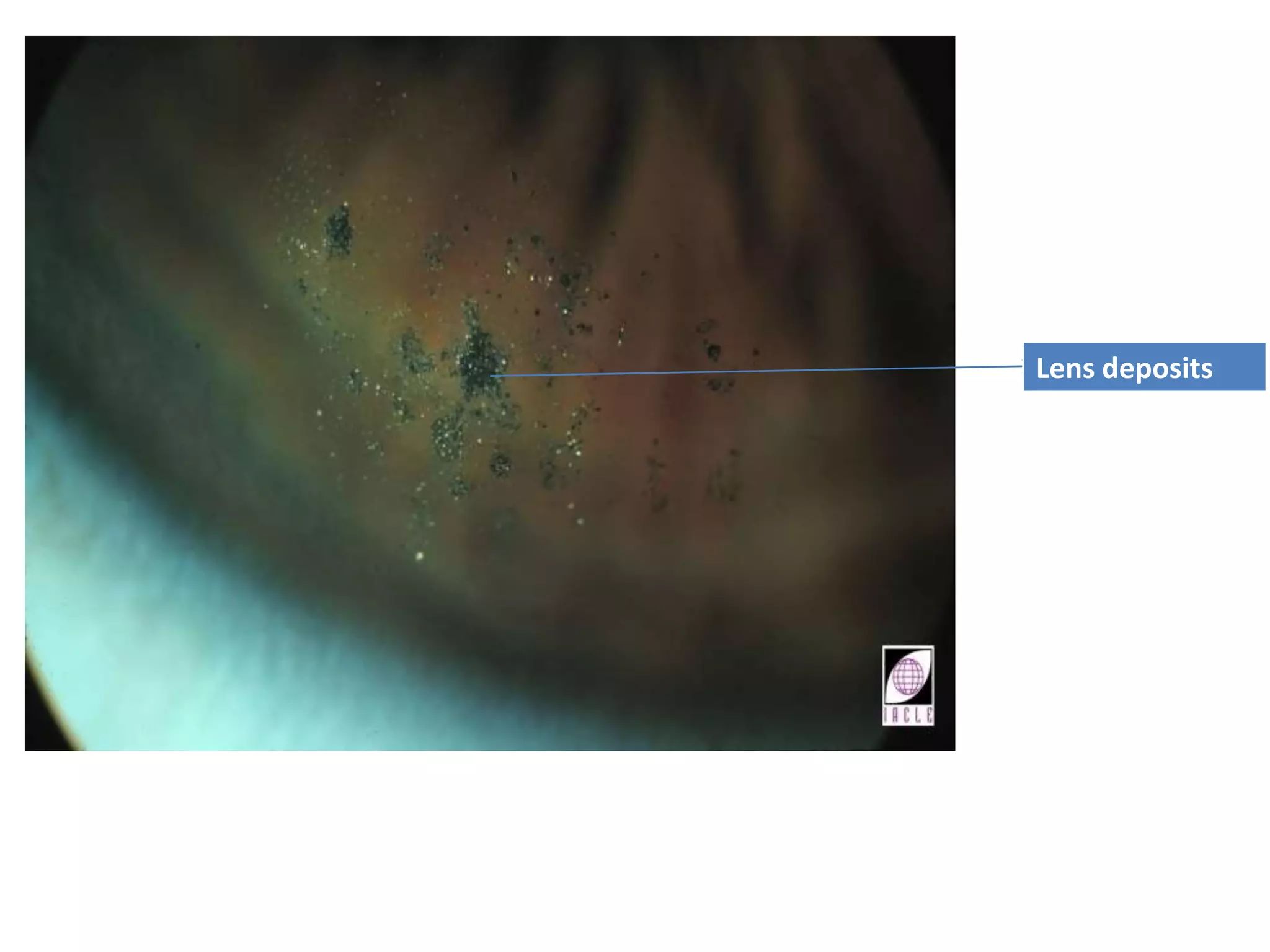 Soft contact lens complications | PPTX
