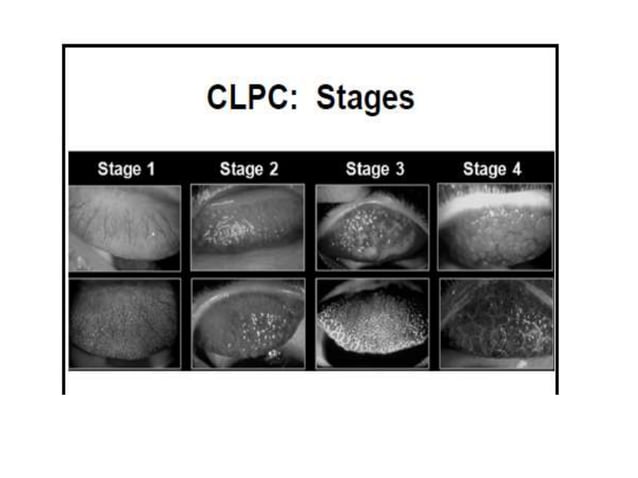 Soft contact lens complications | PPTX