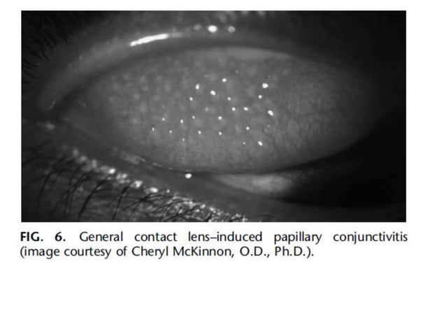 Soft contact lens complications | PPTX