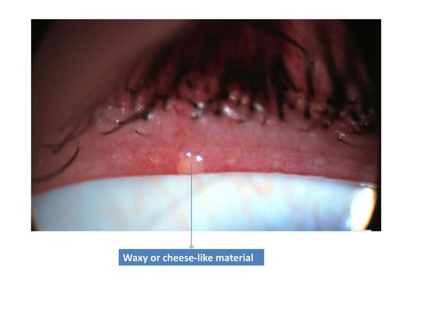 Soft contact lens complications | PPTX