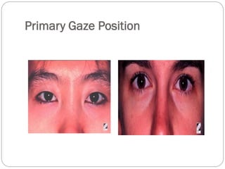Soft Contact Lens Fitting.pdf