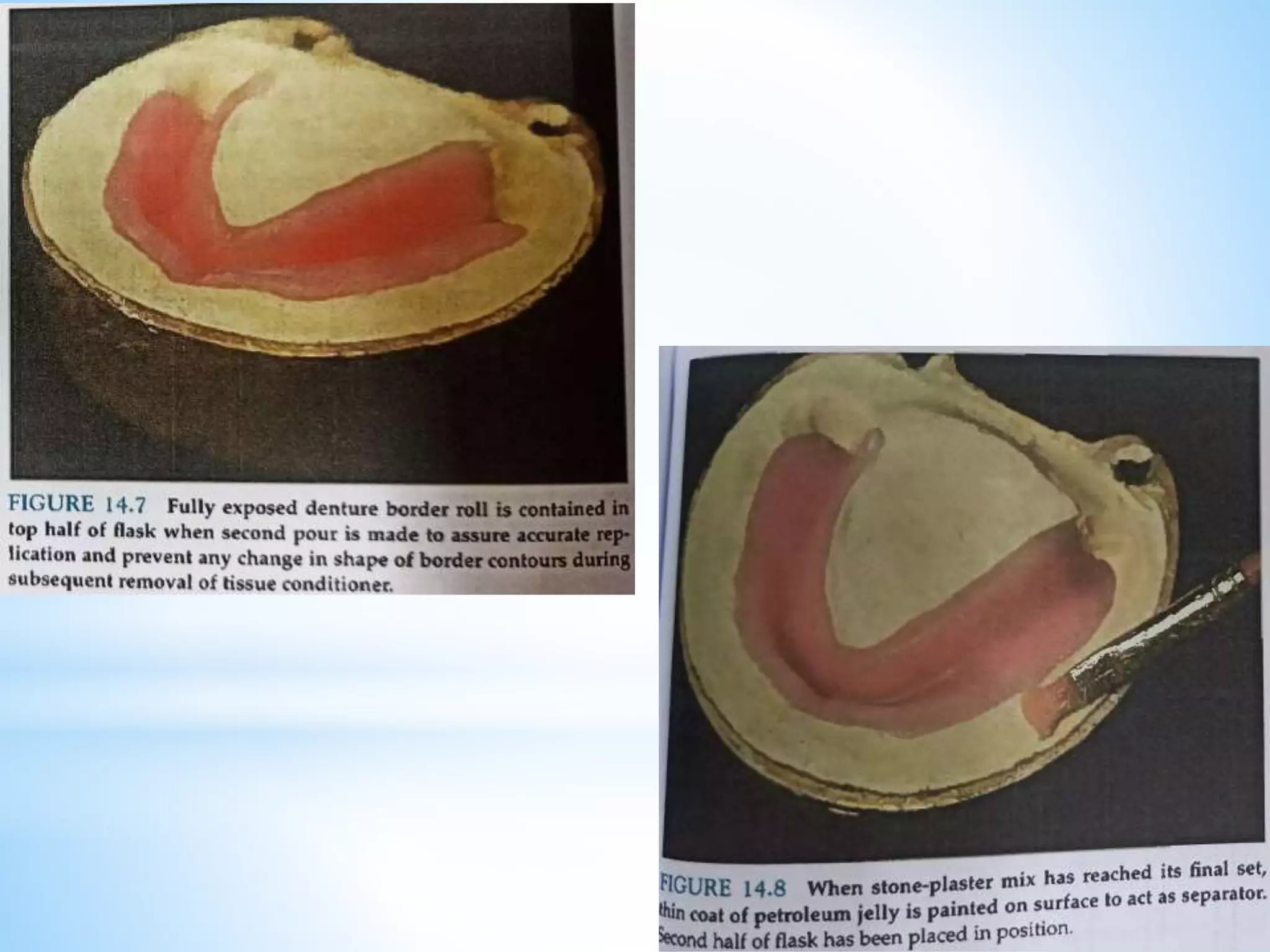 Soft liners and tissue conditioners | PPTX