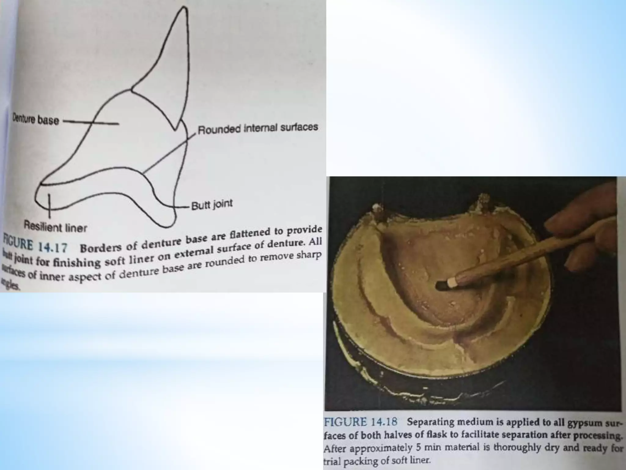 Soft liners and tissue conditioners | PPTX