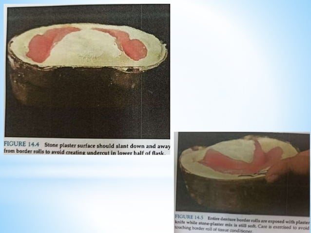 Soft liners and tissue conditioners | PPTX | Dental Health | Diseases ...