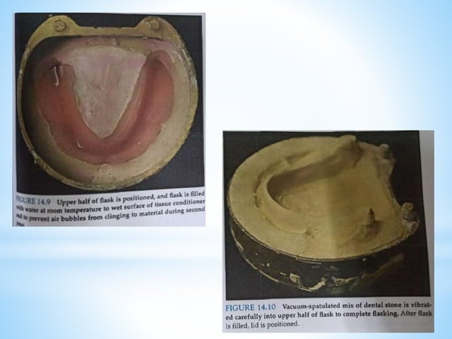 Soft liners and tissue conditioners | PPTX | Dental Health | Diseases ...