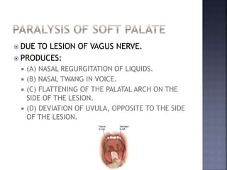 Soft Palate | PPTX