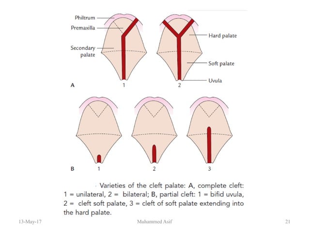 Soft palate for MBBS | PDF | Ear, Nose and Throat Conditions | Diseases ...