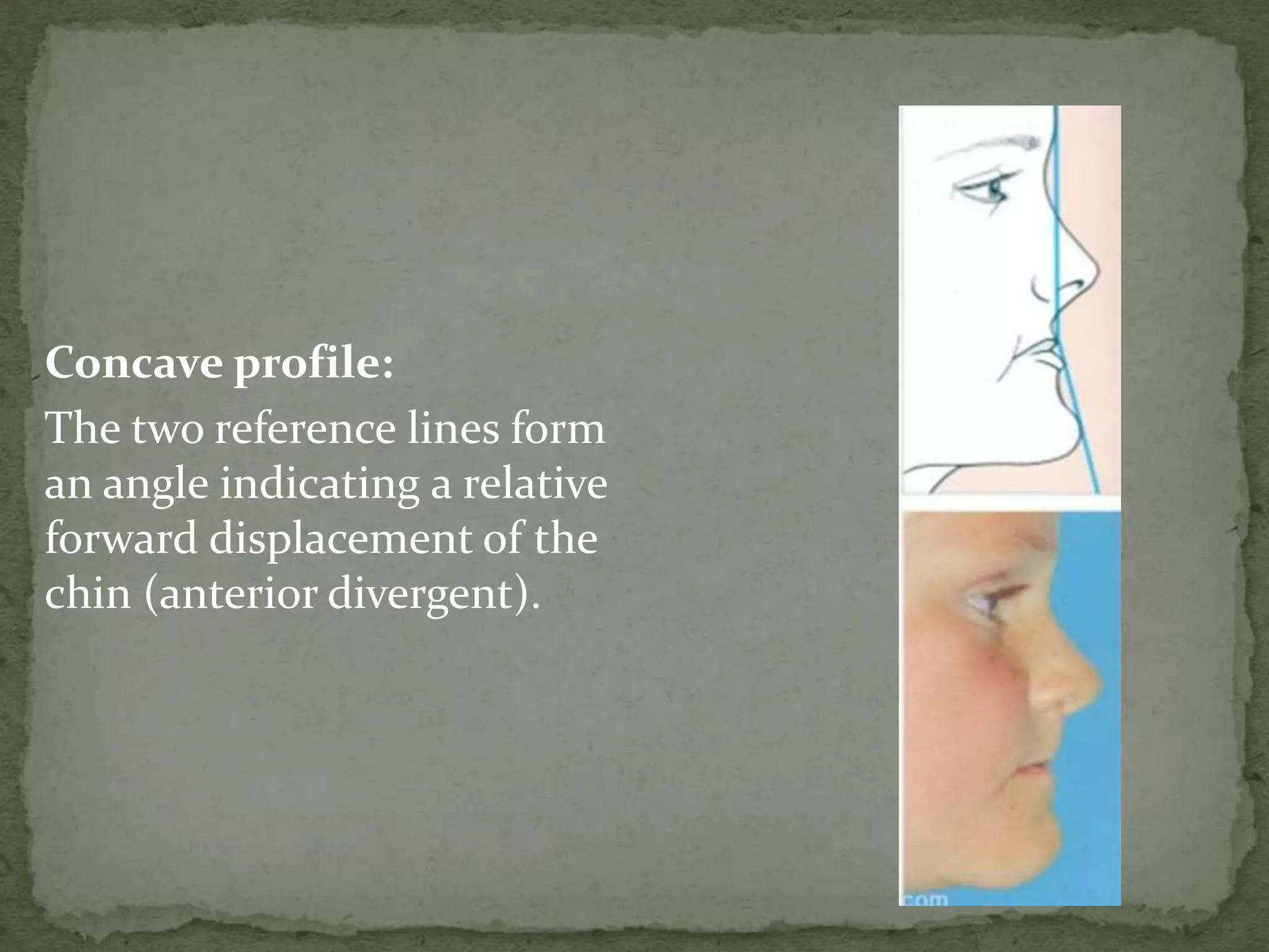 Soft tissue analysis | PPTX