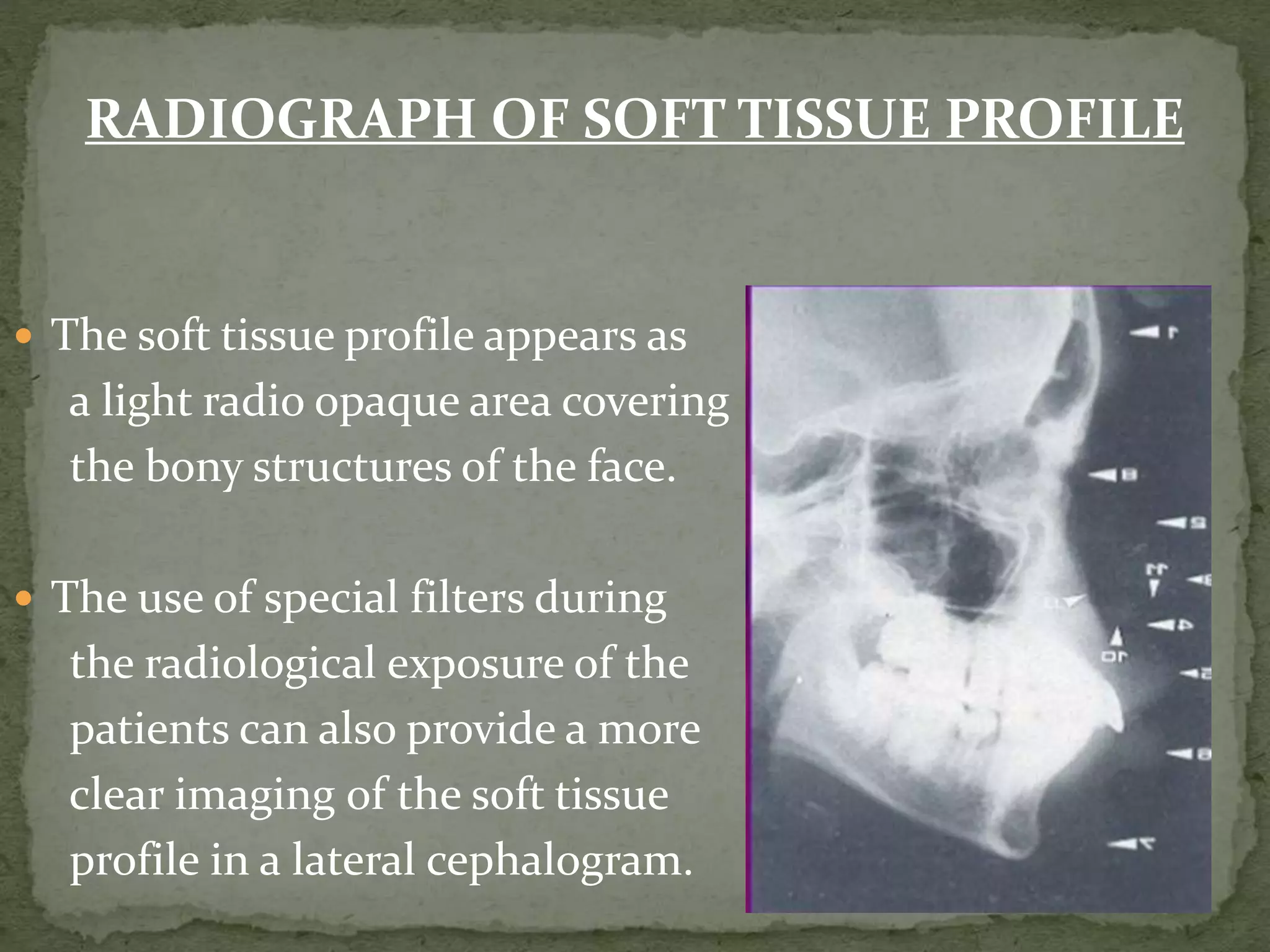 Soft tissue analysis | PPTX