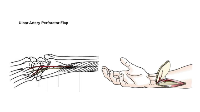 Soft tissue anatomy for hand flaps | PPTX