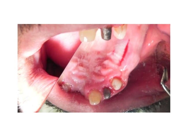 Soft tissue augmentation | PPT