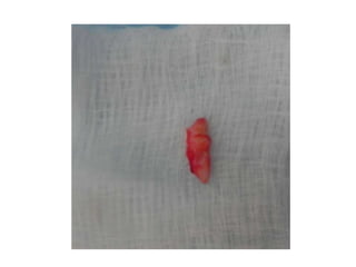 Soft tissue augmentation | PPT